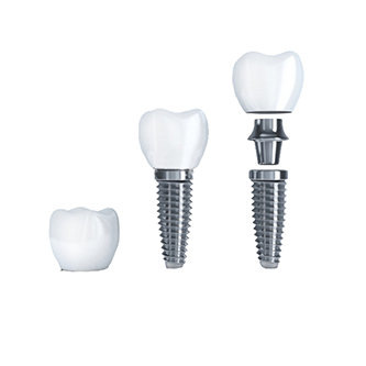 Elite Dental Laboratory Implants